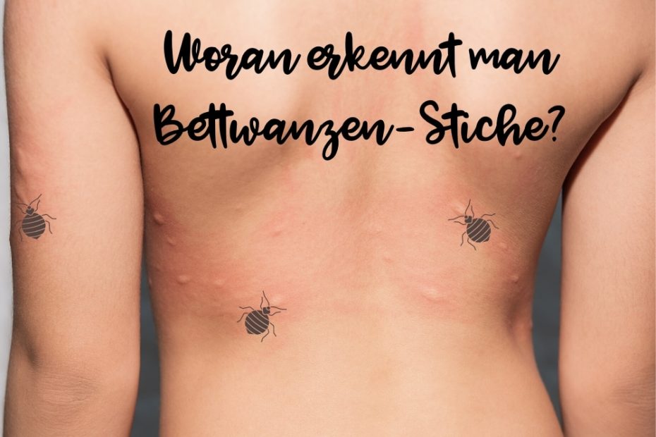 Bettwanzen-Stiche erkennen: so sehen sie aus
