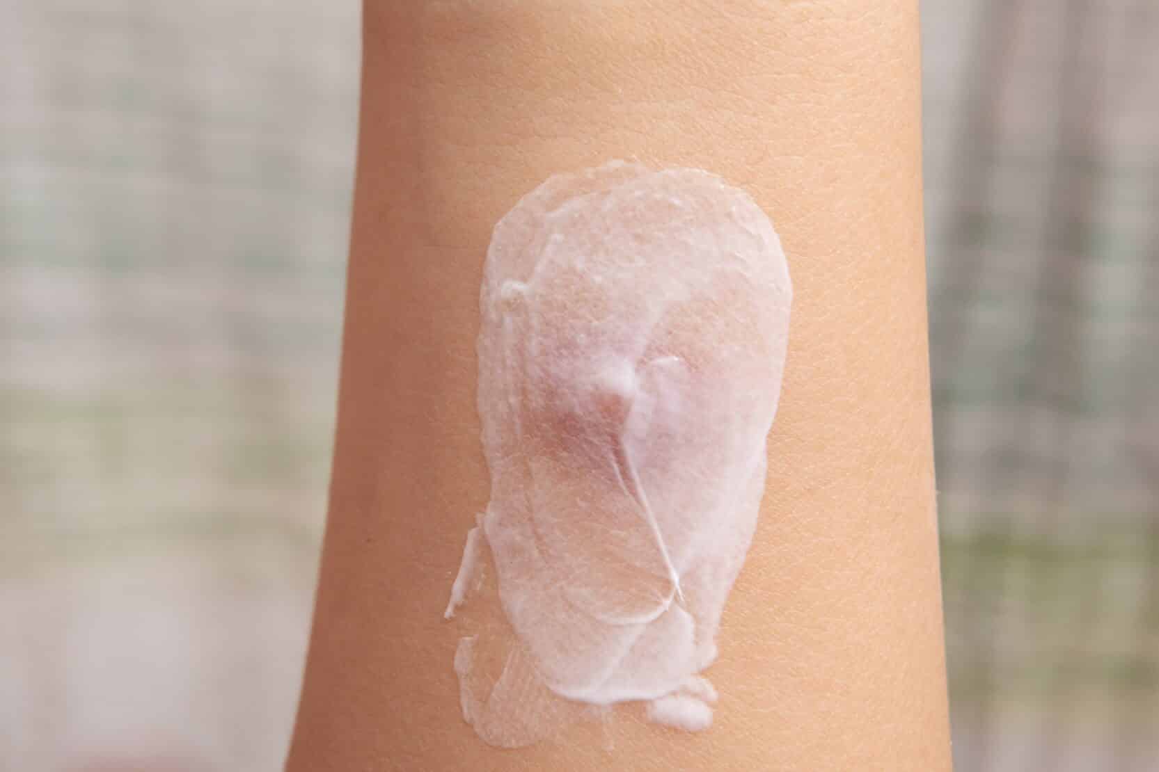 Was Tun Bei Kriebelmuckenstich